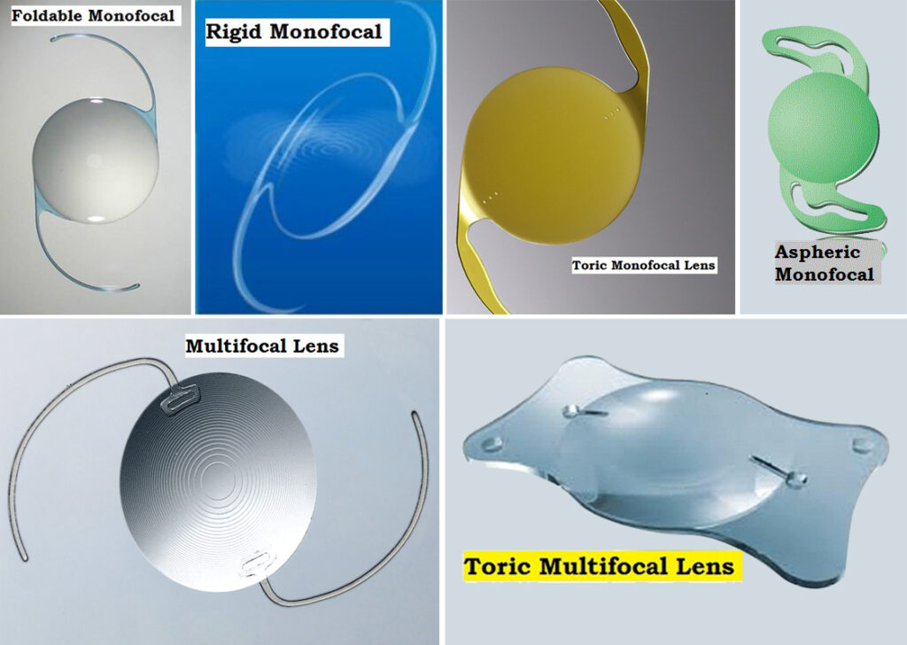 What are the Different Types of Lens for Cataract Eye?